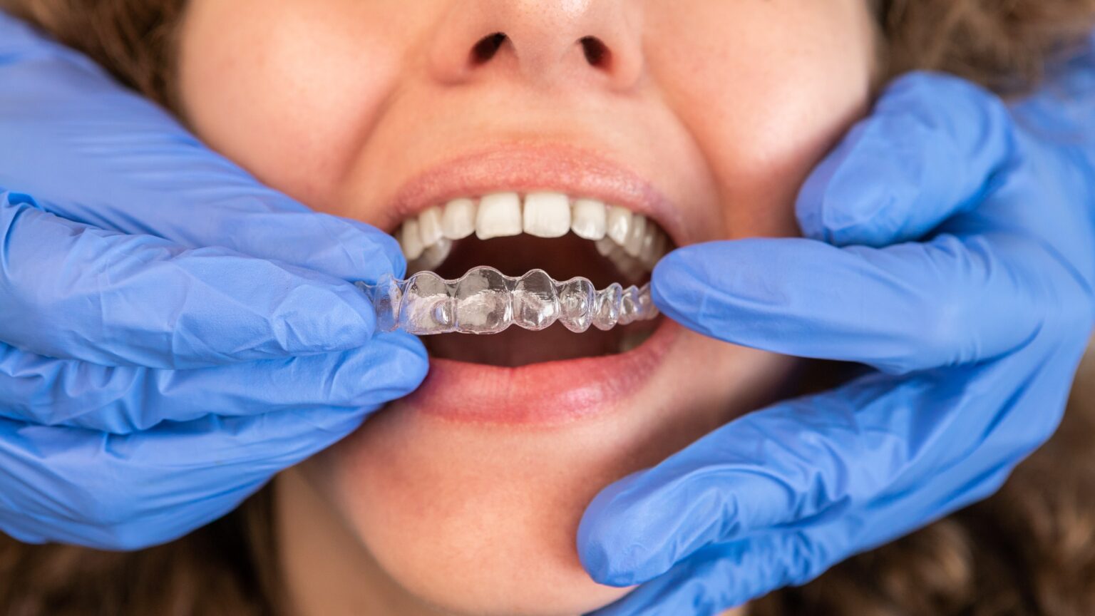 How to Clean Invisalign: A Comprehensive Step-by-Step Guide